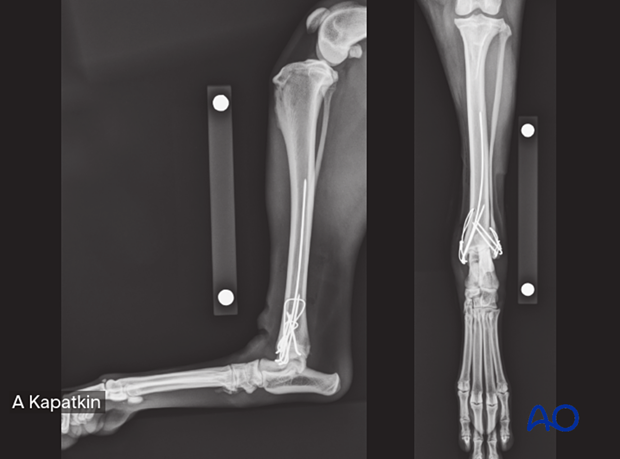 Pin and tension band fixation for Partial articular multimalleolar ...