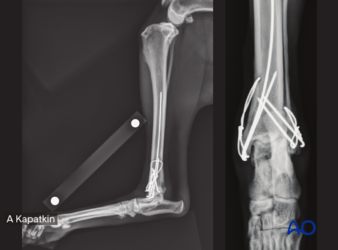 Pin and tension band fixation for Partial articular multimalleolar ...