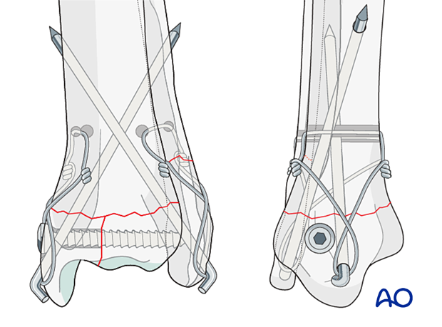 Pins and tension band with lag screw fixation for Simple articular ...