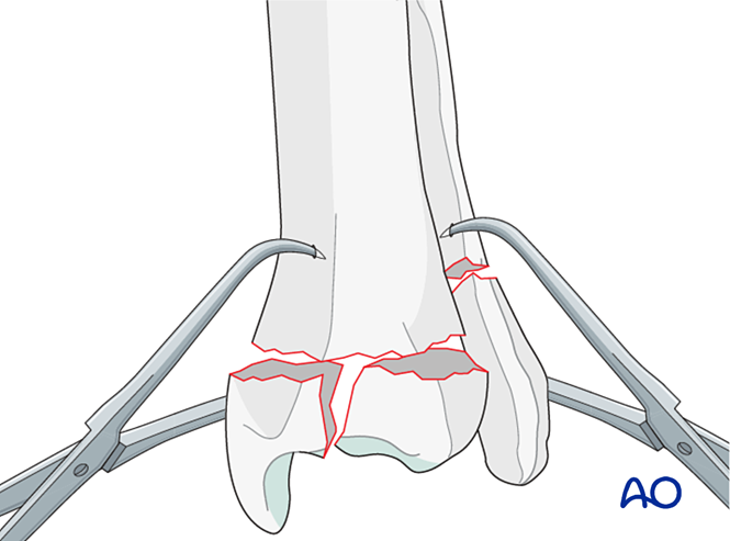 Pins and tension band with lag screw fixation for Simple articular ...