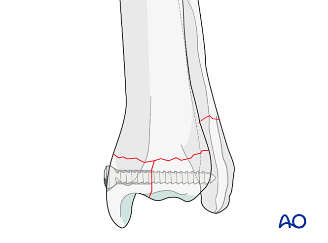Pins and tension band with lag screw fixation for Simple articular ...
