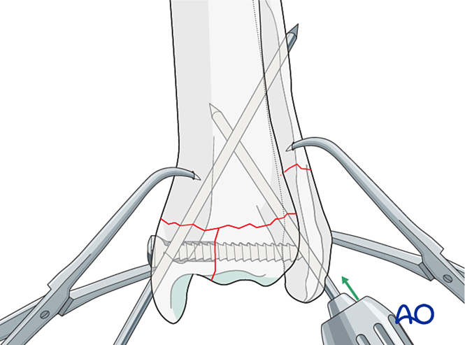 Pins and tension band with lag screw fixation for Simple articular ...
