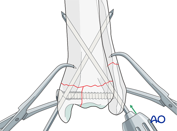 Pins and tension band with lag screw fixation for Simple articular ...