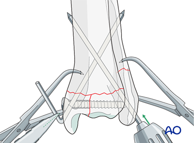 Pins and tension band with lag screw fixation for Simple articular ...