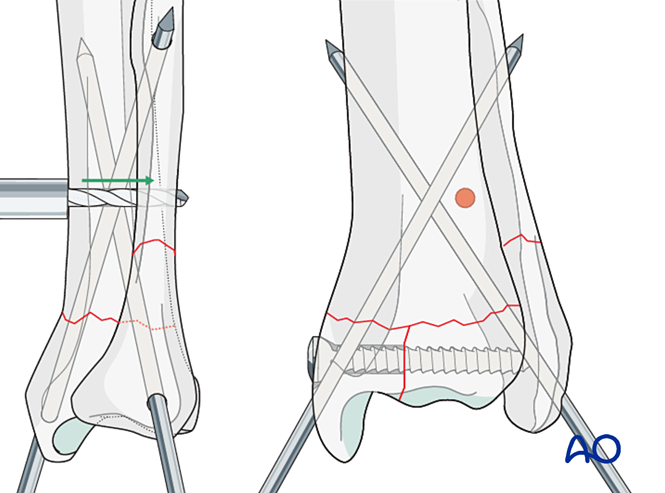Pins and tension band with lag screw fixation for Simple articular ...