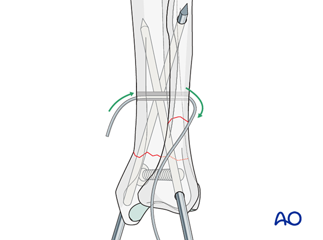 Pins and tension band with lag screw fixation for Simple articular ...