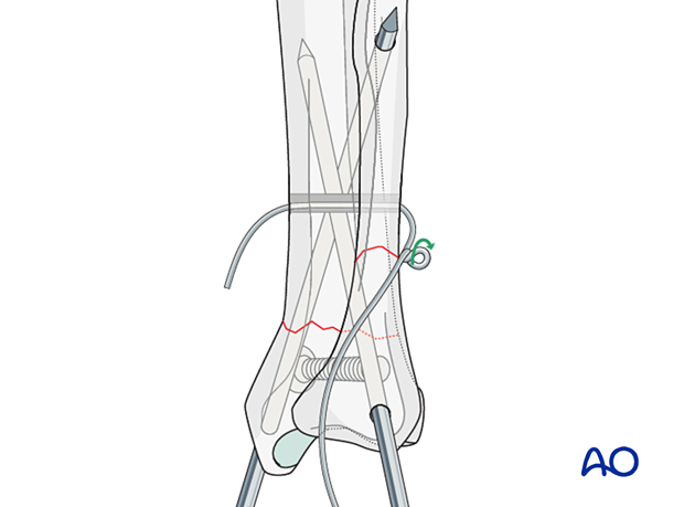 Pins and tension band with lag screw fixation for Simple articular ...