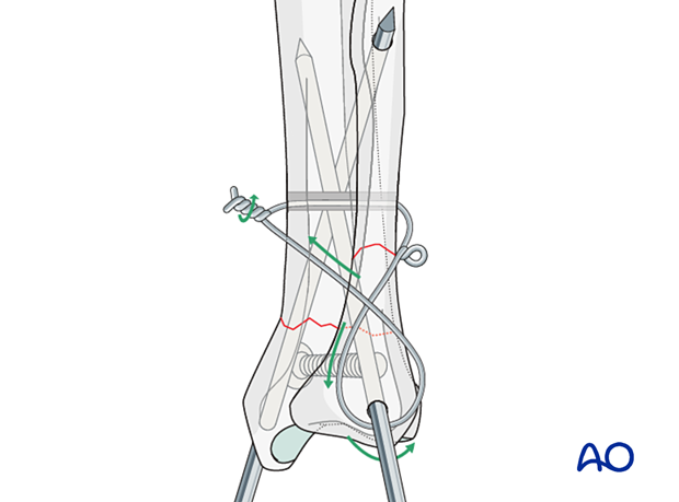 Pins and tension band with lag screw fixation for Simple articular ...