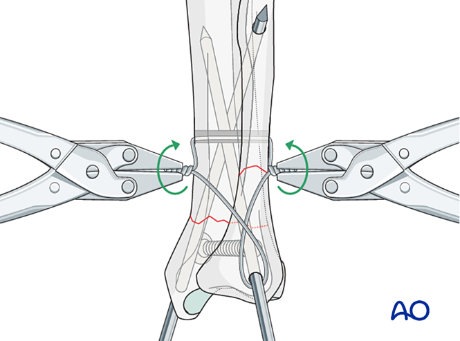 Pins and tension band with lag screw fixation for Simple articular ...