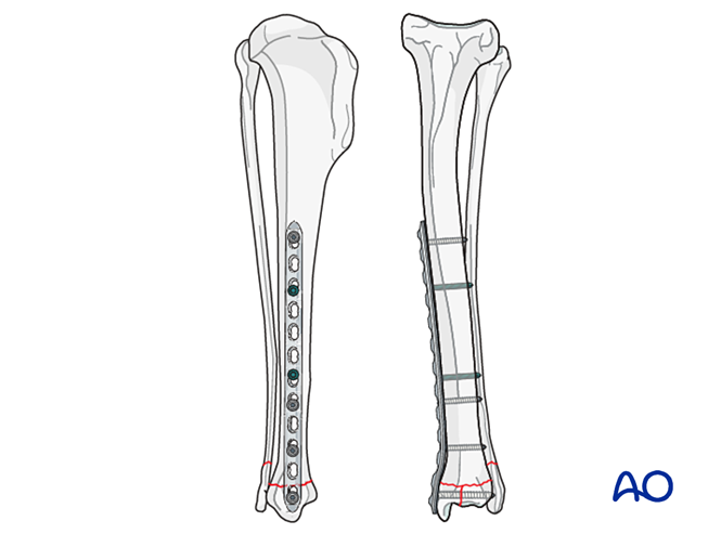 Medial plating with lag screw fixation for Simple articular, simple ...