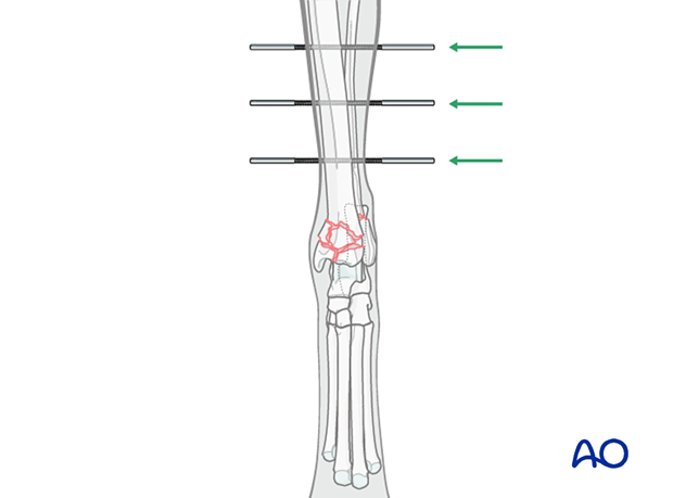 Transarticular external skeletal fixation (pantarsal arthrodesis) for ...