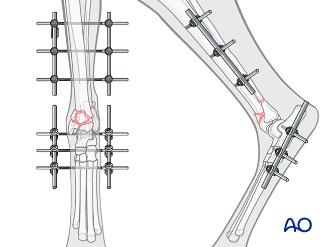 Transarticular external skeletal fixation (pantarsal arthrodesis) for ...