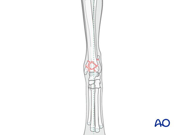 Plate fixation (pantarsal arthrodesis) for Multifragmentary articular ...