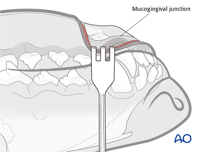 Ventral approach to the rostral mandible