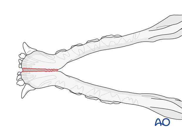 Mandible symphyseal separation