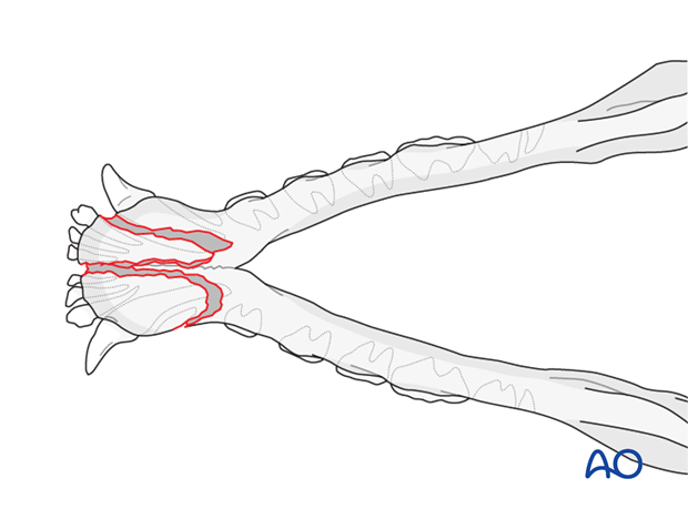 Mandible parasymphyseal simple fracture