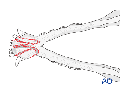 Parasymphyseal comminuted fracture