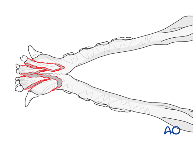 Parasymphyseal comminuted fracture