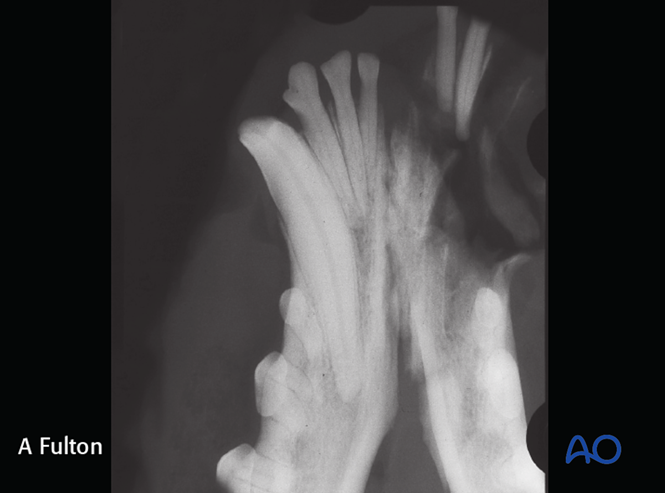 Mandible parasymphyseal simple fracture