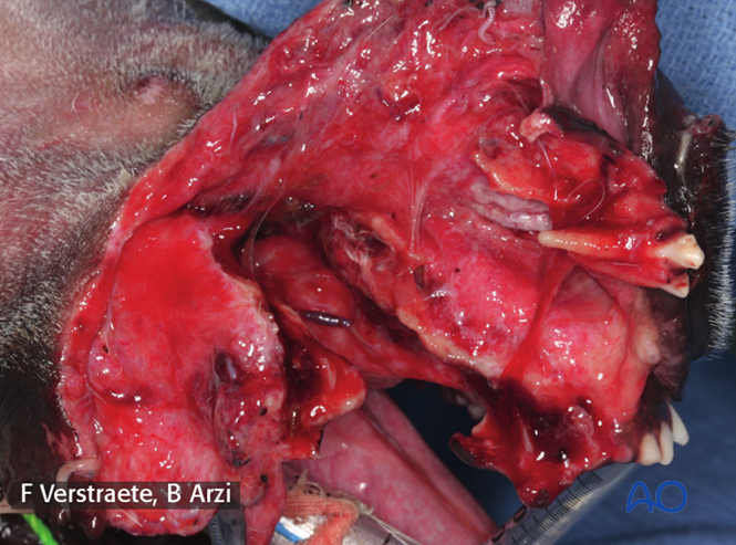 Parasymphyseal comminuted fracture