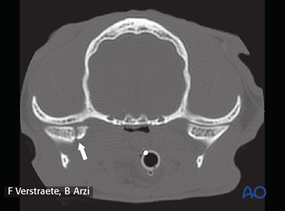 Condylectomy for Mandible, Temporomandibular joint fractures
