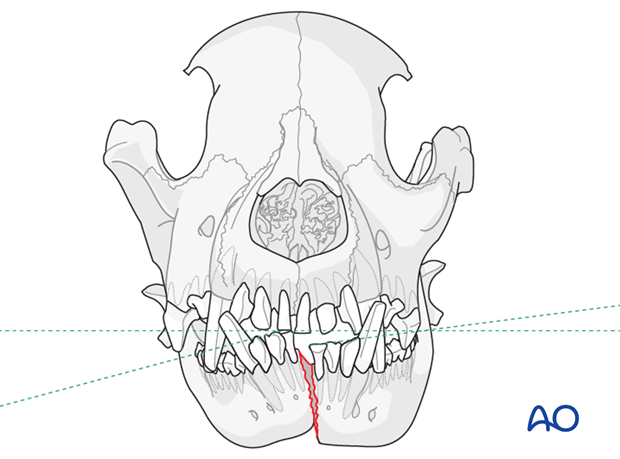 Mandible symphyseal separation