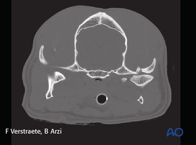 Temporomandibular joint fracture