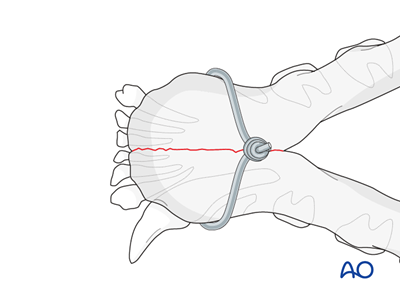 Circummandibular wiring for Mandible, Symphyseal separation