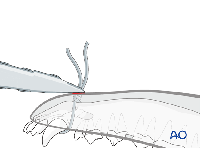 Circummandibular wiring for Mandible, Symphyseal separation