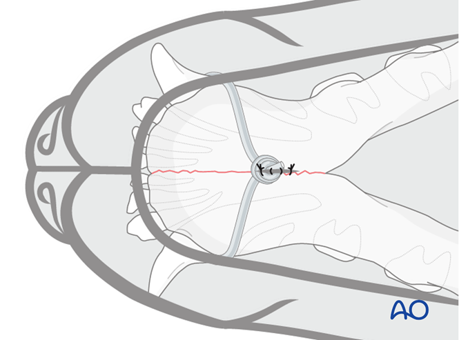 Circummandibular wiring for Mandible, Symphyseal separation