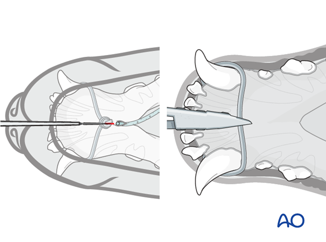 Circummandibular wiring for Mandible, Symphyseal separation