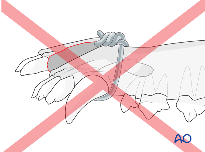 Circummandibular wiring for Mandible, Symphyseal separation