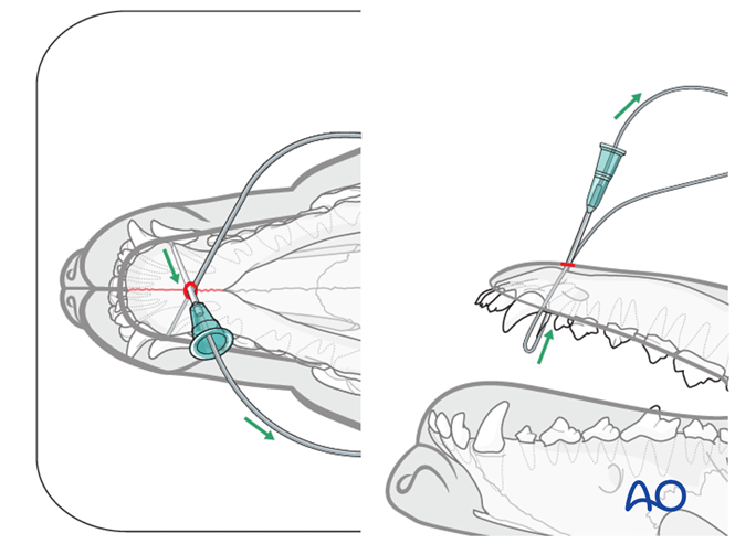 Circummandibular wiring for Mandible, Symphyseal separation