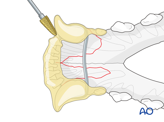 Circummandibular wiring and dental composite for Mandible ...