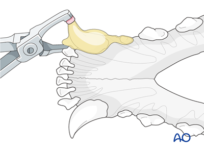 Circummandibular wiring for Mandible, Symphyseal separation
