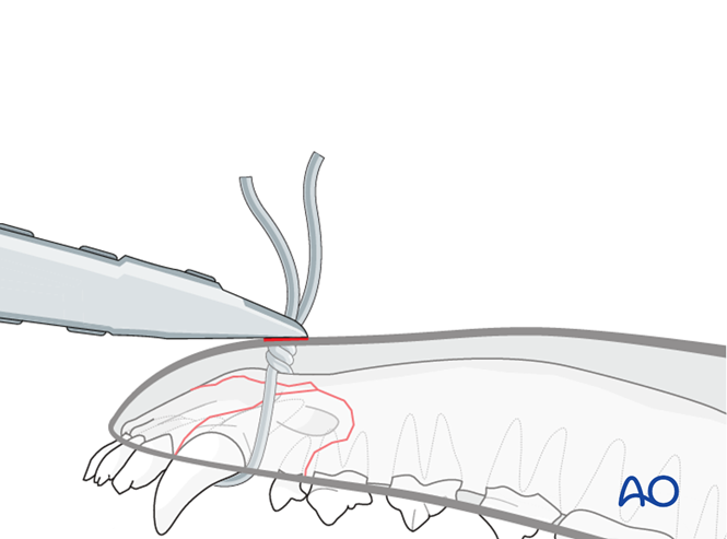 Circummandibular wiring and dental composite for Mandible ...