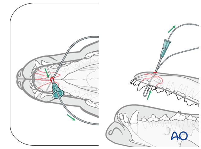 Circummandibular wiring and dental composite for Mandible ...