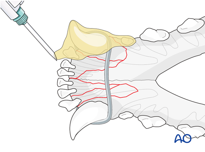 Circummandibular wiring and dental composite for Mandible ...