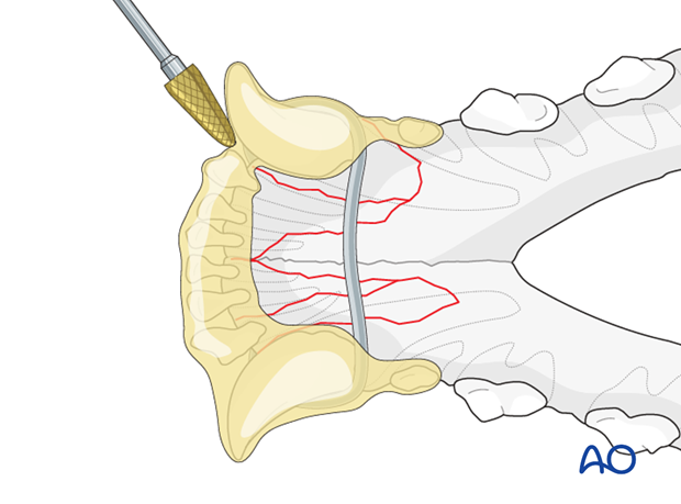Circummandibular wiring and dental composite for Mandible ...