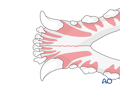 Wire reinforced intraoral splinting for Mandible, Symphyseal separation