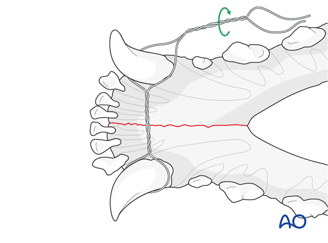 Wire reinforced intraoral splinting for Mandible, Symphyseal separation