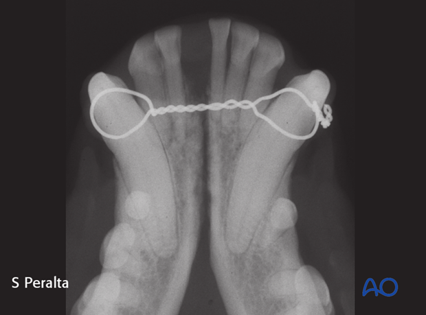 Wire reinforced intraoral splinting for Mandible, Symphyseal separation