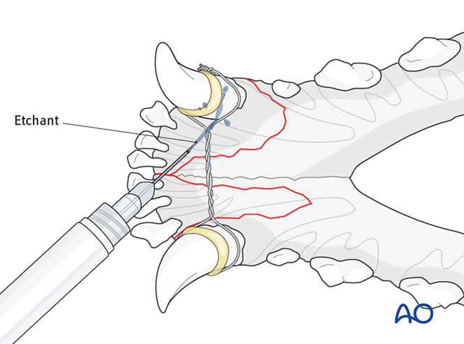 Wire reinforced intraoral splinting for Mandible, Parasymphyseal ...