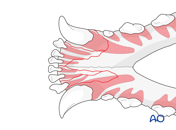 Wire reinforced intraoral splinting for Mandible, Parasymphyseal ...