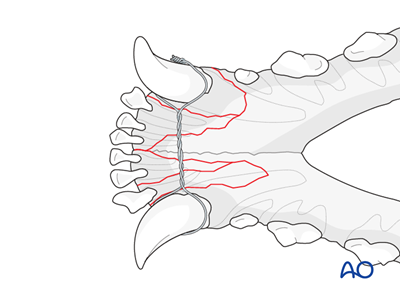 Wire reinforced intraoral splinting for Mandible, Parasymphyseal ...