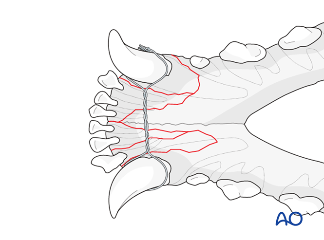 Wire reinforced intraoral splinting for Mandible, Parasymphyseal ...