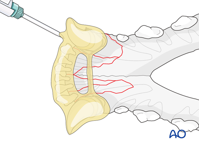 Wire reinforced intraoral splinting for Mandible, Parasymphyseal ...