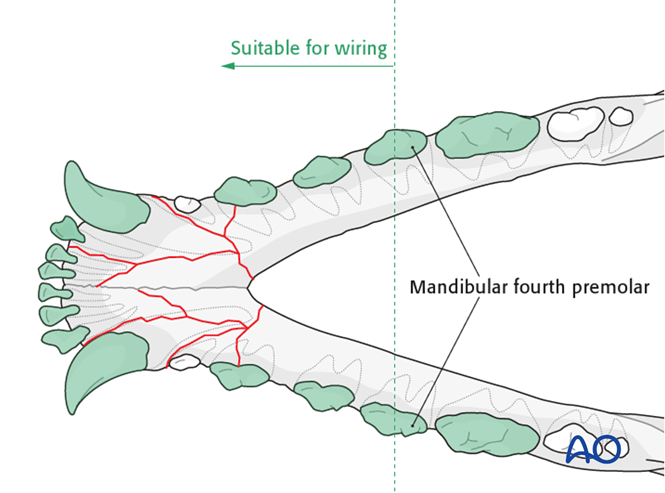 Wire reinforced intraoral splinting for Mandible, Rostral: Bilateral ...