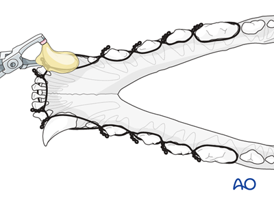 Wire reinforced intraoral splinting for Mandible, Body: Bilateral simple