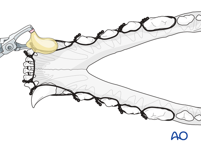 Wire reinforced intraoral splinting for Mandible, Body: Bilateral ...